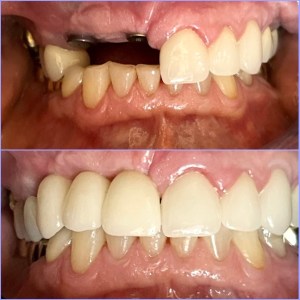 Before & After Dental Photos Great Falls MT, Smile Gallery